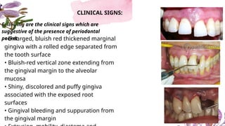 periodontal disease.ppt periodontal pocket | PPTX