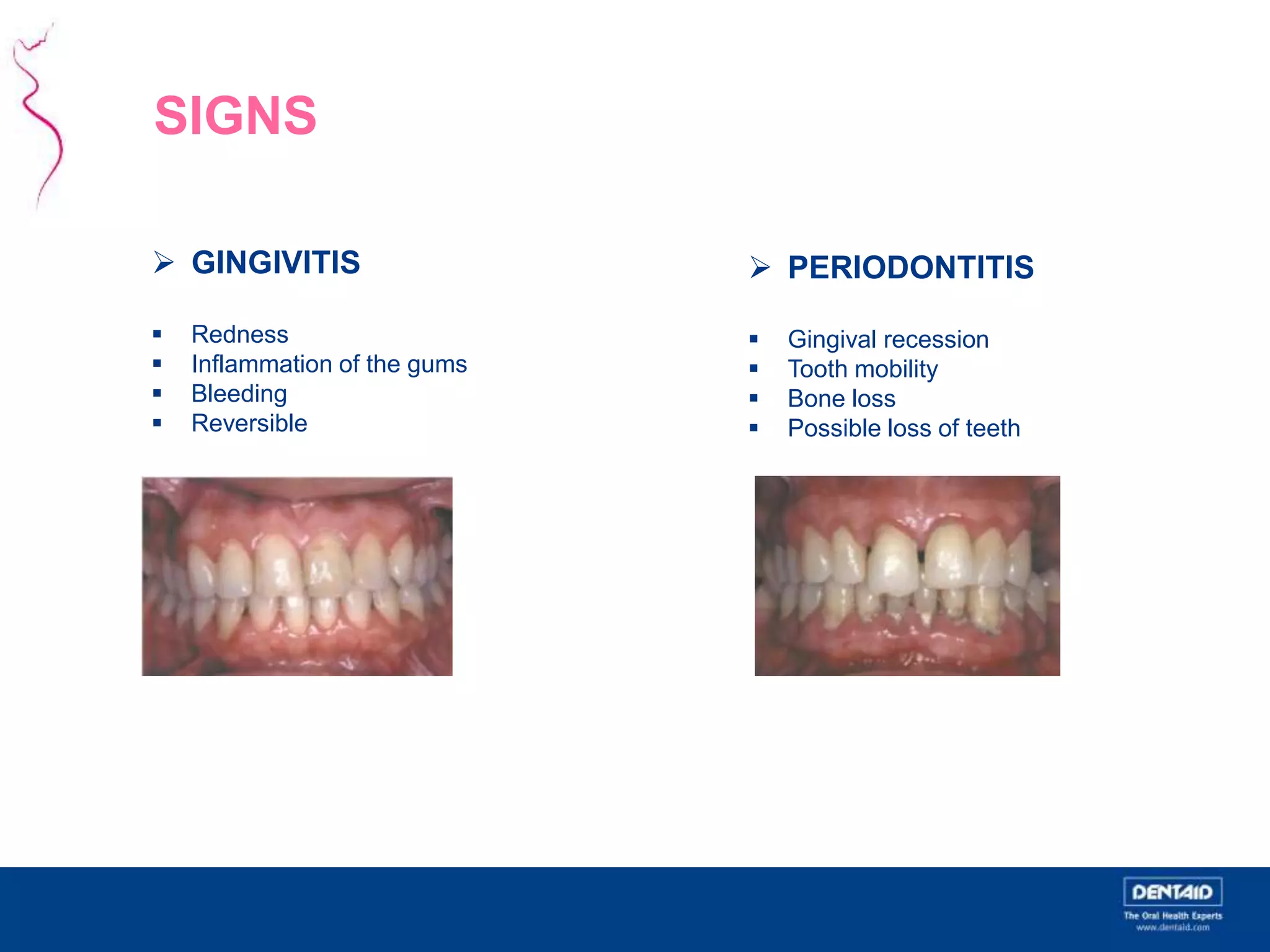 Periodontal disease and pregnancy | PPTX