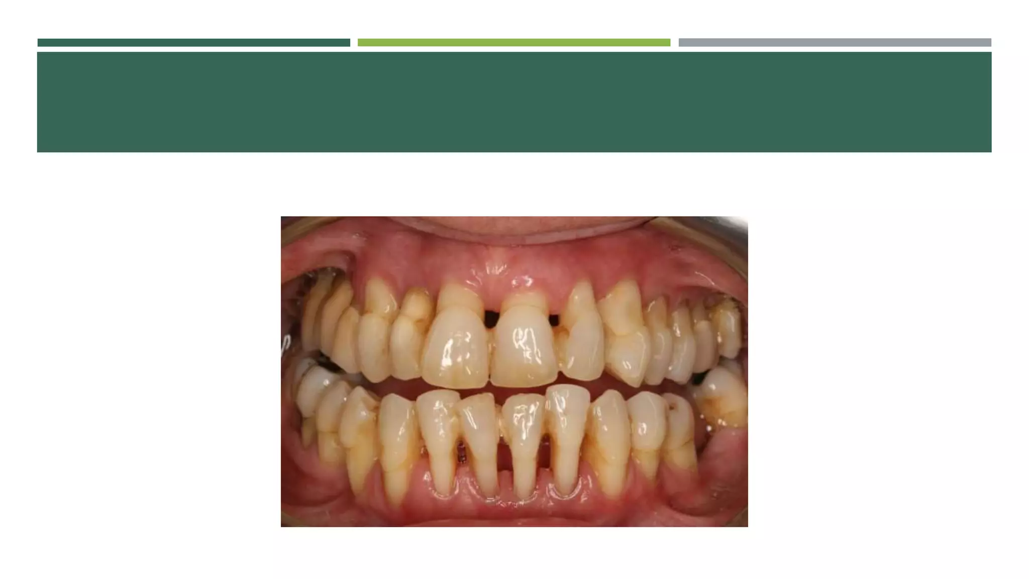 Periodontal Disease PowerPoint | PPTX