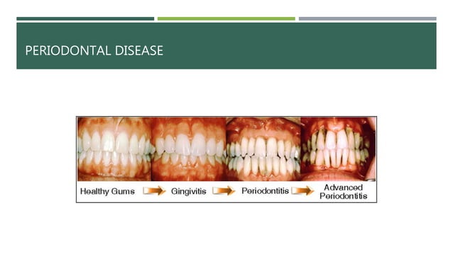 Periodontal Disease PowerPoint | PPTX