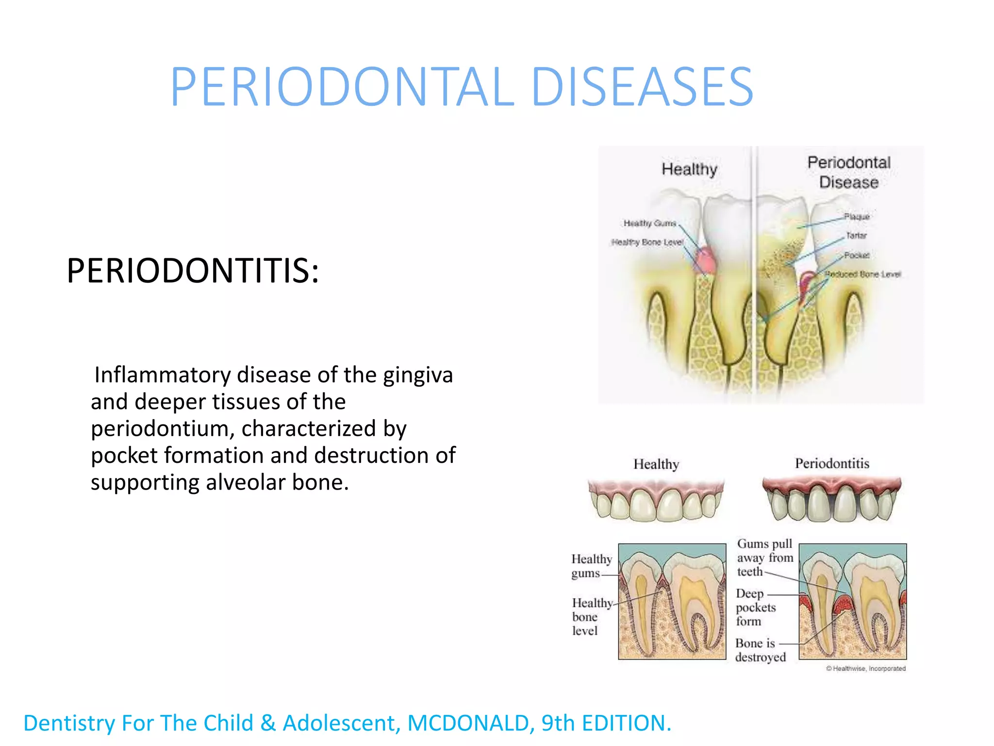 Periodontal disease in children -pedodontics | PPTX