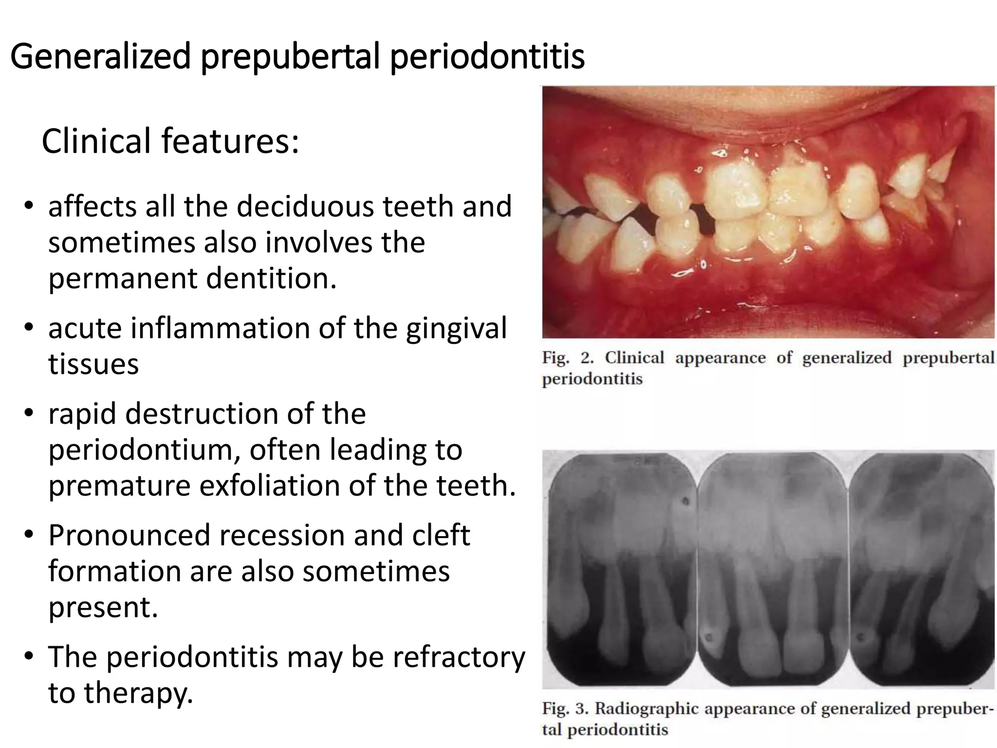 Periodontal disease in children -pedodontics | PPTX