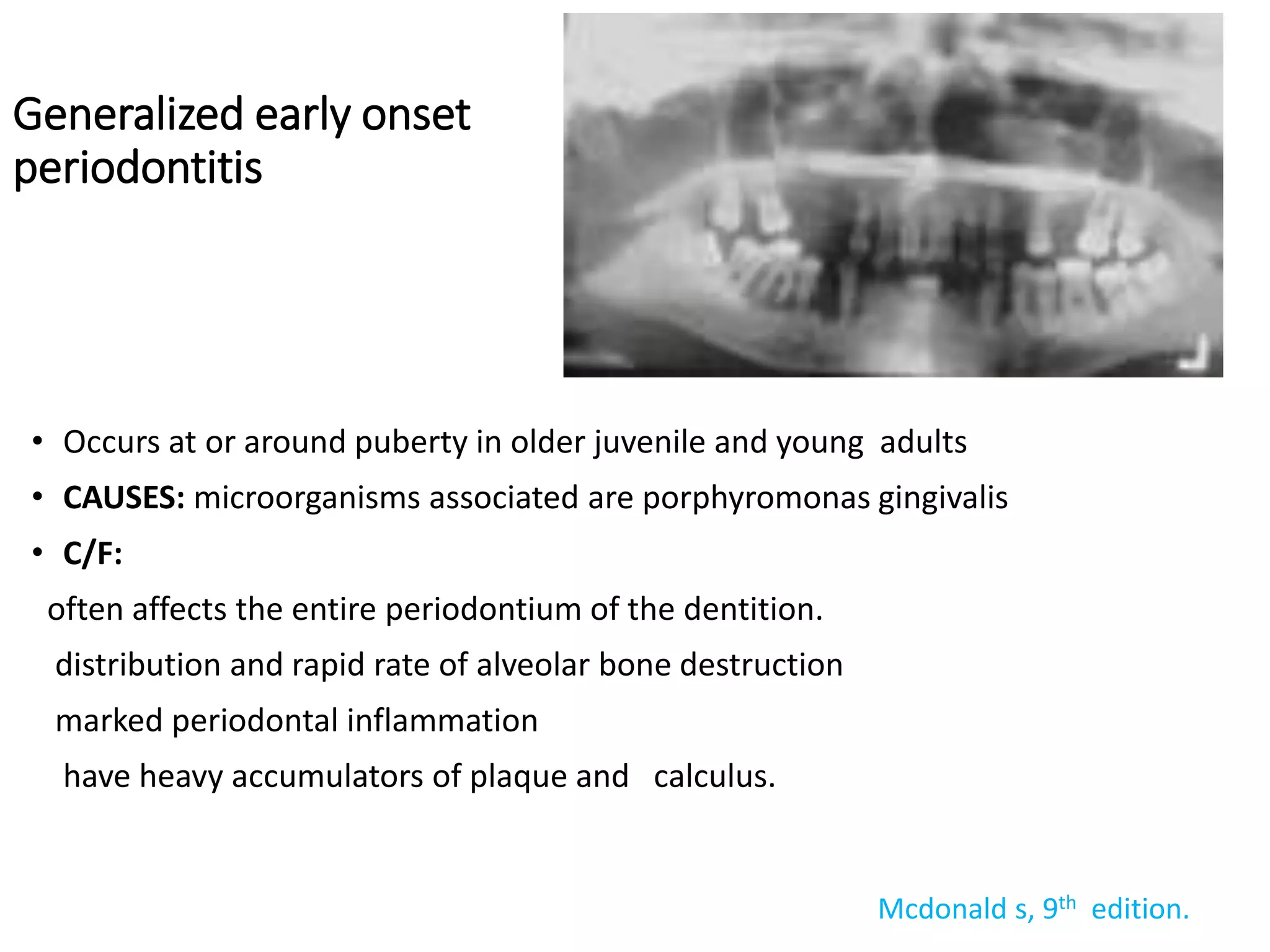 Periodontal disease in children -pedodontics | PPTX