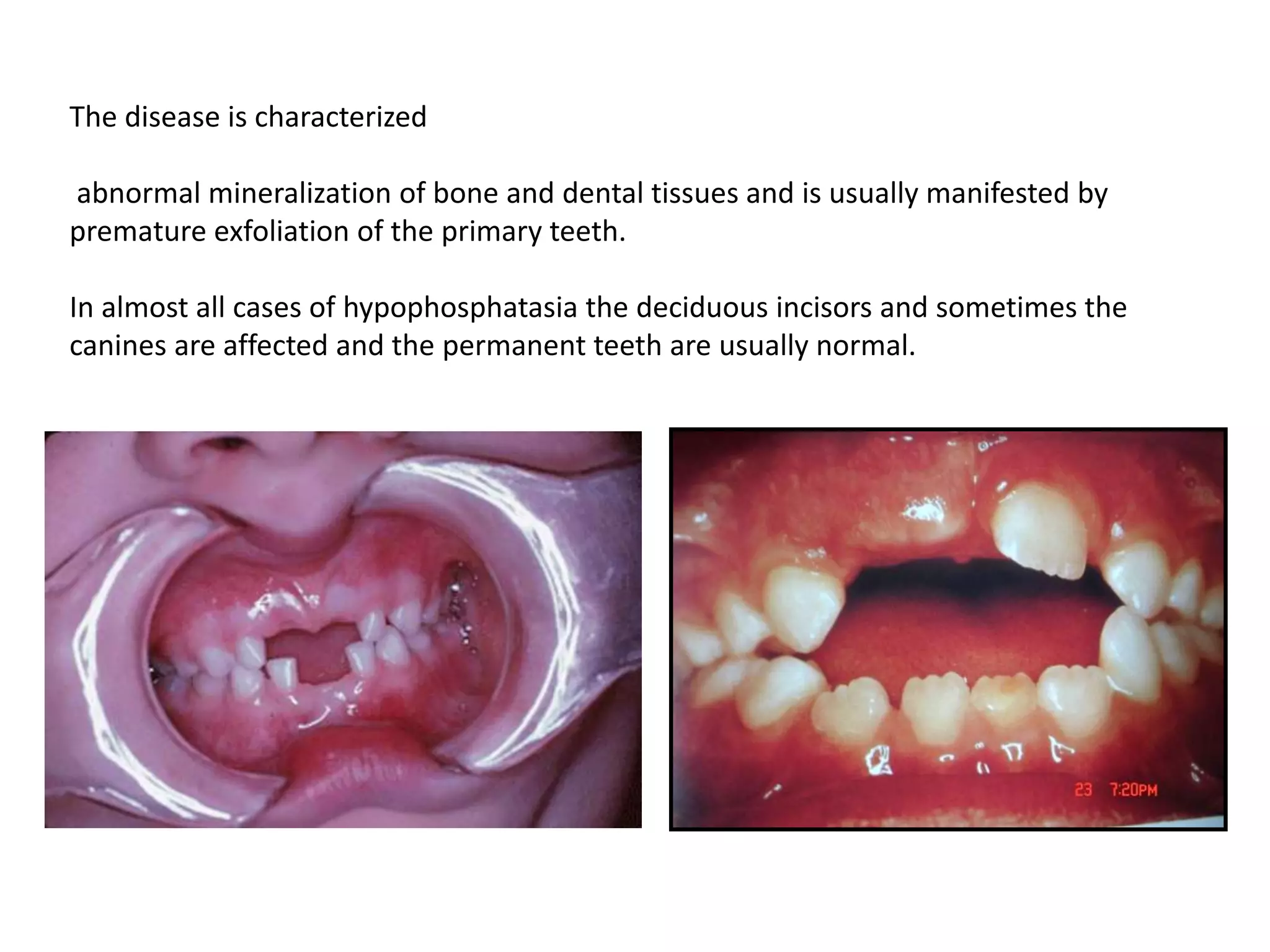 Periodontal disease in children -pedodontics | PPTX