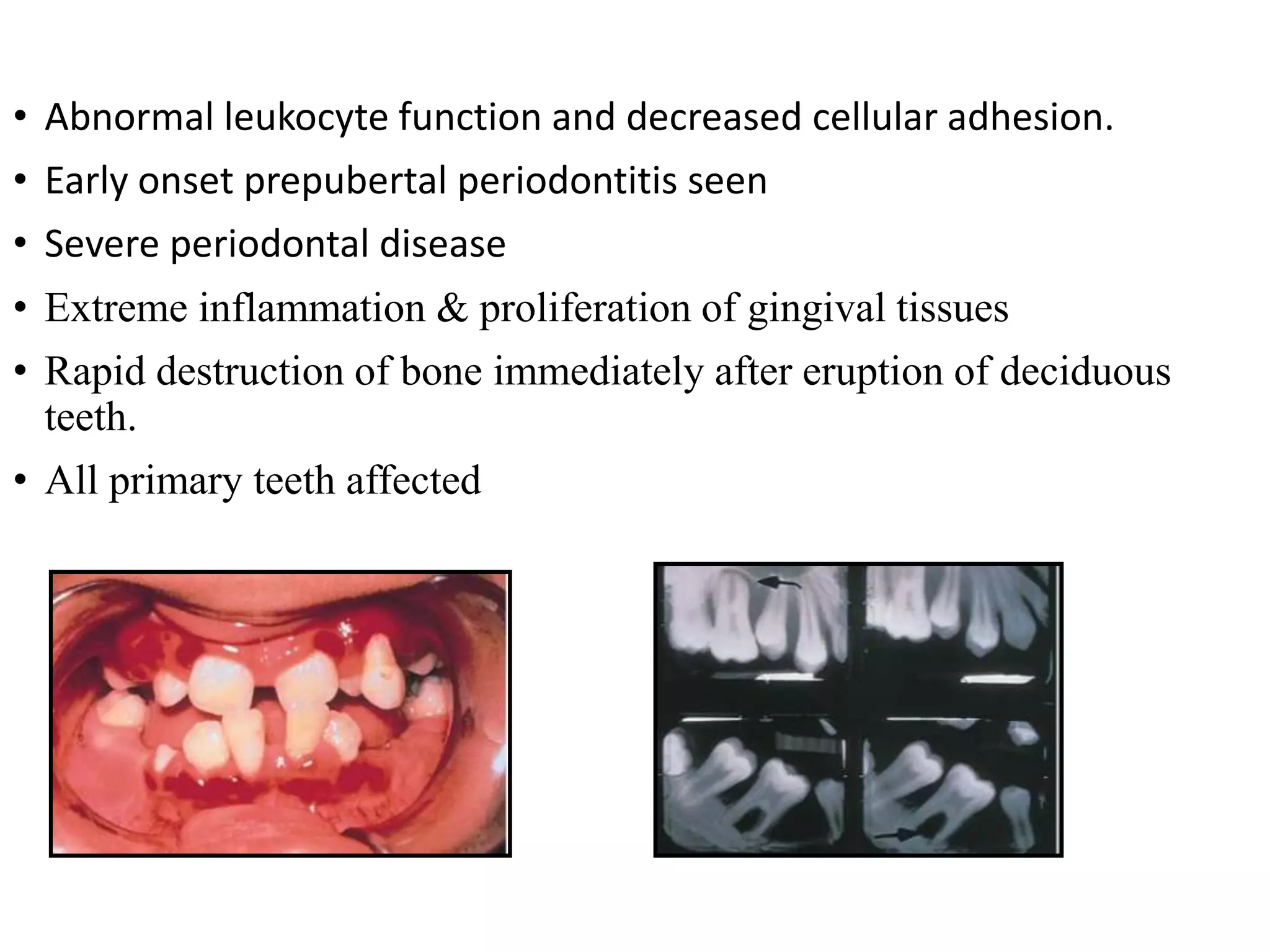 Periodontal disease in children -pedodontics | PPTX