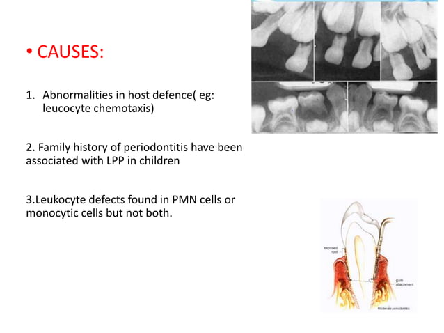 Periodontal disease in children -pedodontics | PPTX