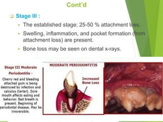 Periodontal diseases | PPTX