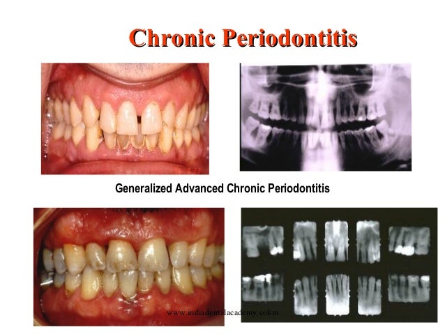 Periodontal diseases iii / dental implant courses by Indian dental ac…