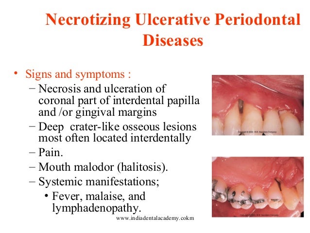 Necrotizing Ulcerative Periodontal Disease
