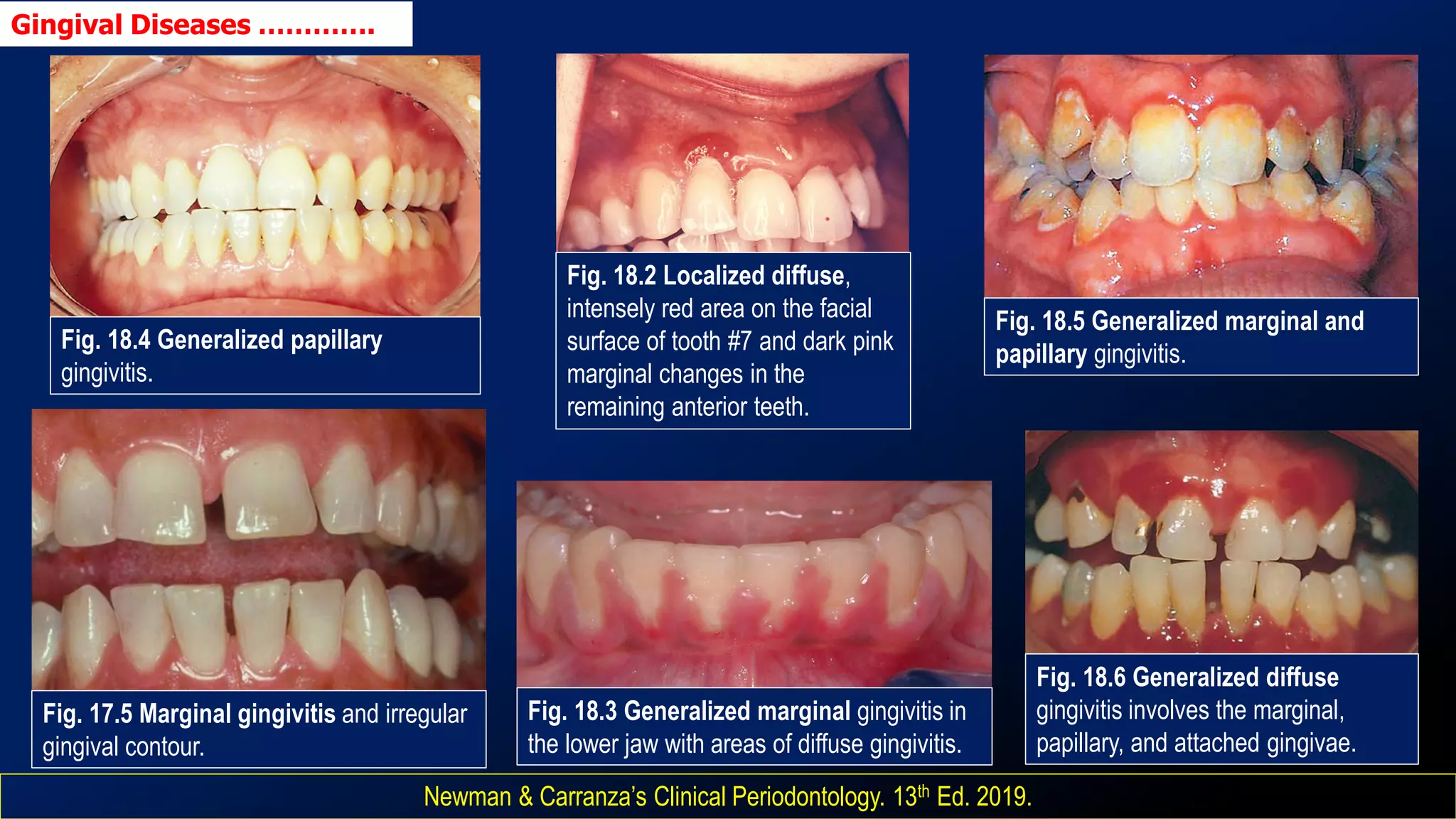 Periodontal diseases Classifications and treatments | PDF