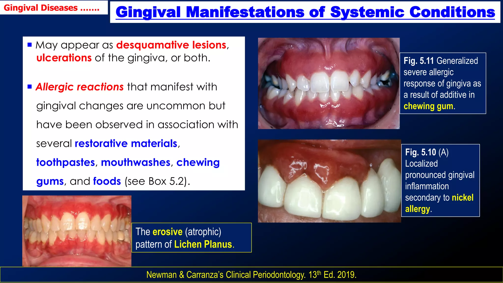 Periodontal diseases Classifications and treatments | PDF