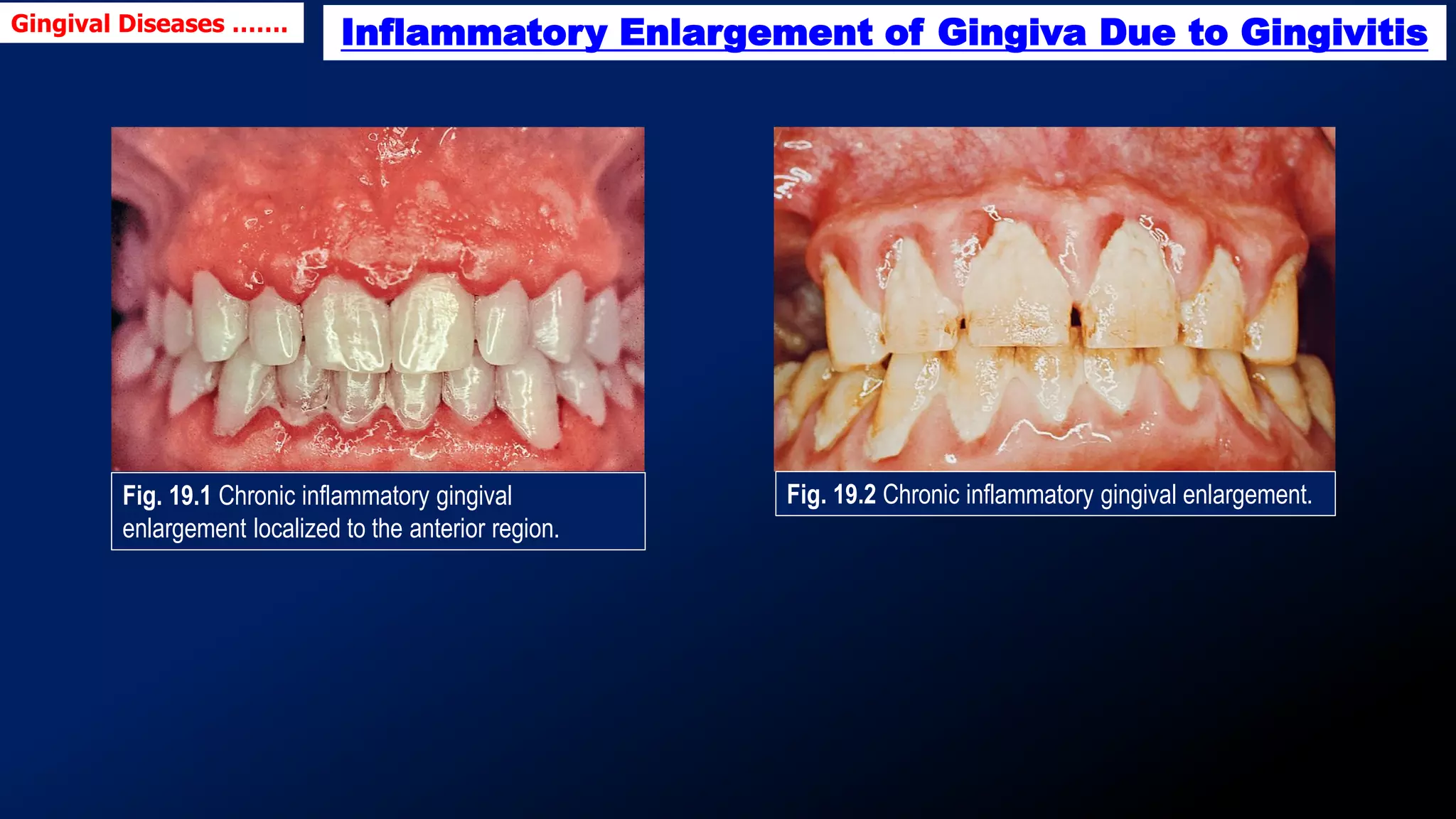Periodontal diseases Classifications and treatments | PDF