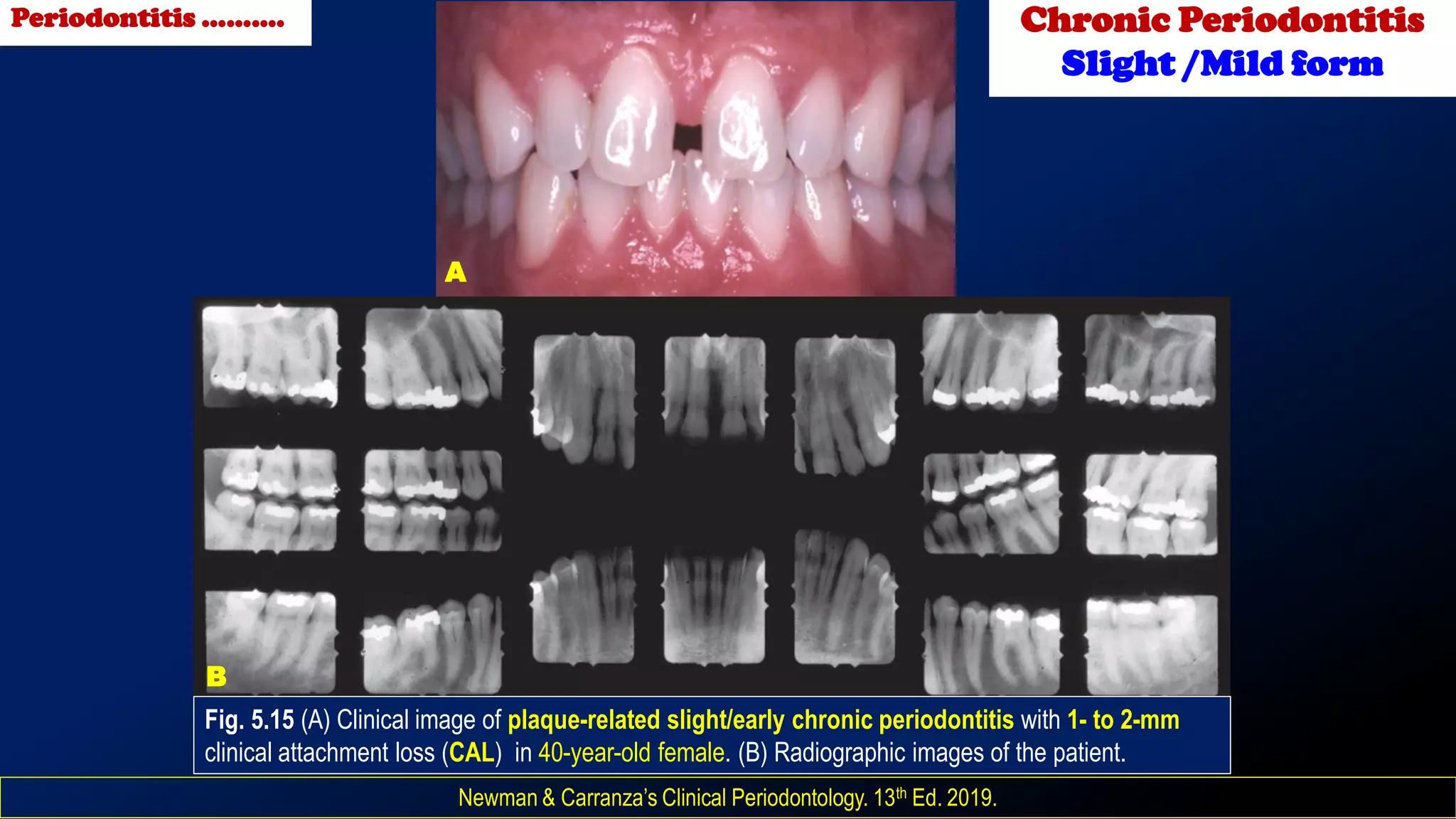 Periodontal diseases Classifications and treatments | PDF