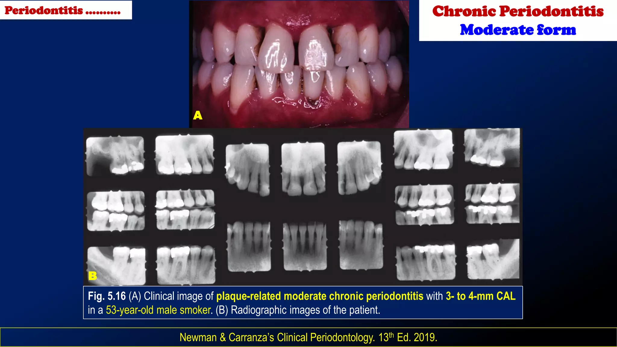 Periodontal diseases Classifications and treatments | PDF