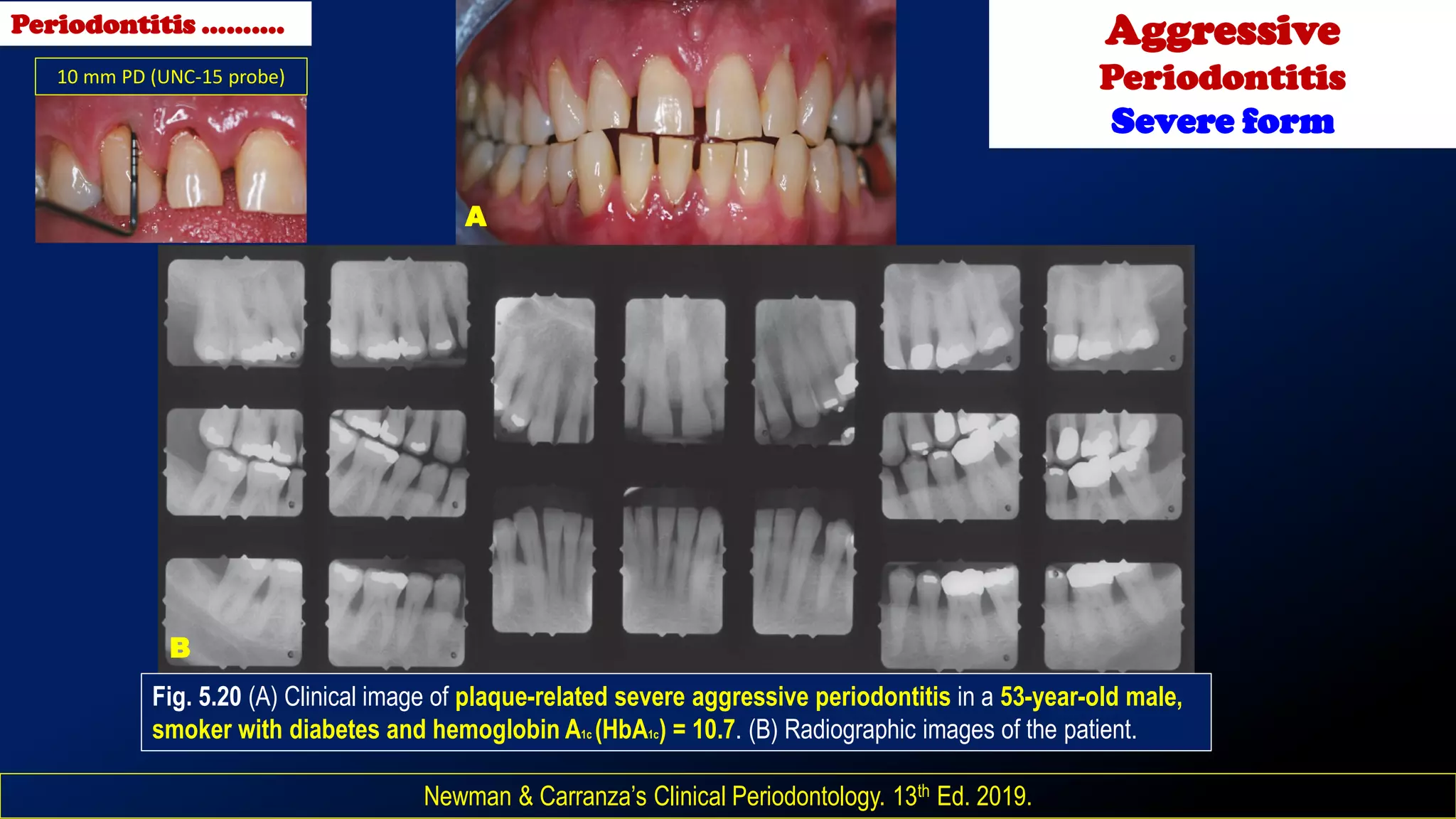 Periodontal diseases Classifications and treatments | PDF