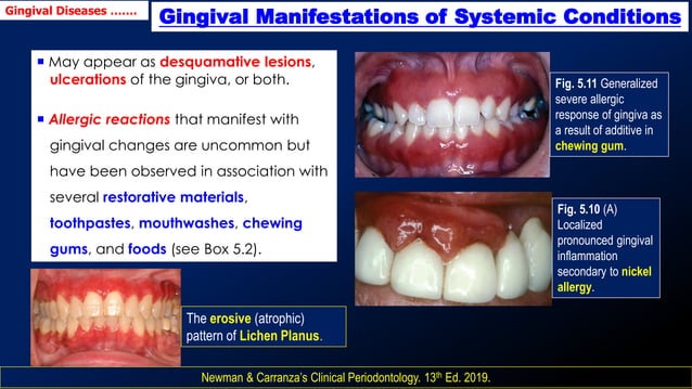 Periodontal diseases Classifications and treatments | PDF