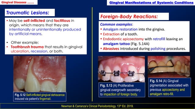 Periodontal diseases Classifications and treatments | PDF