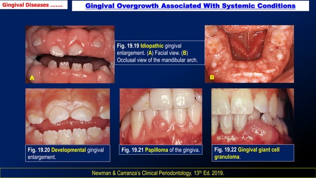 Periodontal diseases Classifications and treatments | PDF