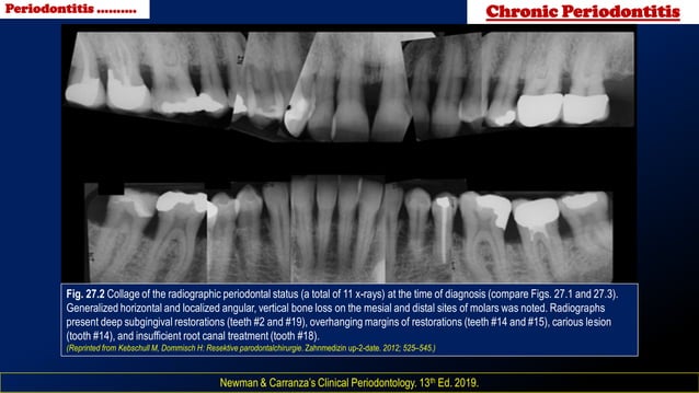 Periodontal diseases Classifications and treatments | PDF