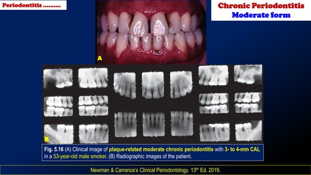 Periodontal diseases Classifications and treatments | PDF