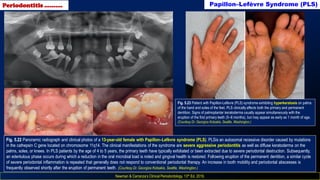 Periodontal diseases Classifications and treatments | PDF