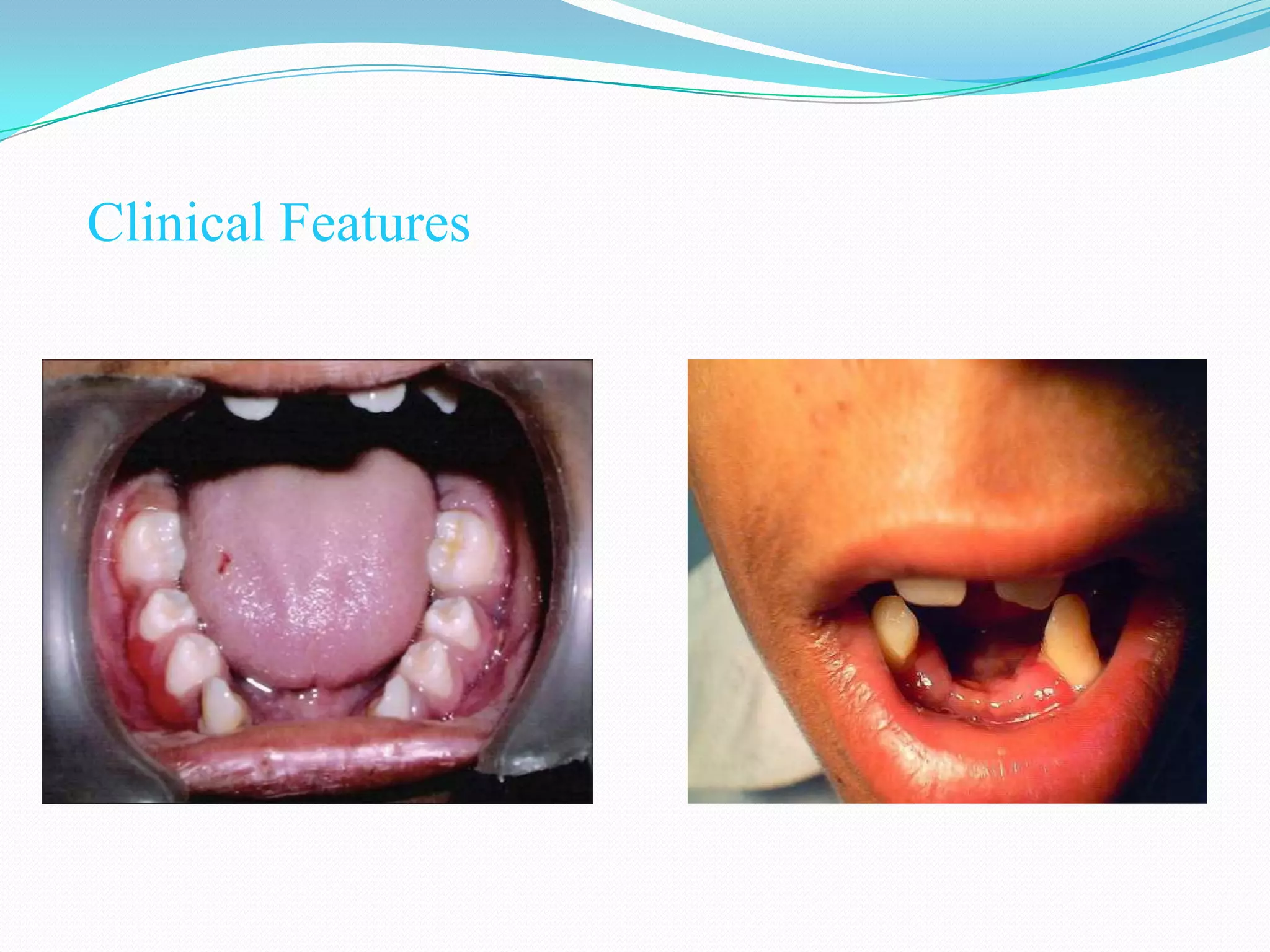 Periodontal diseases in children | PPTX