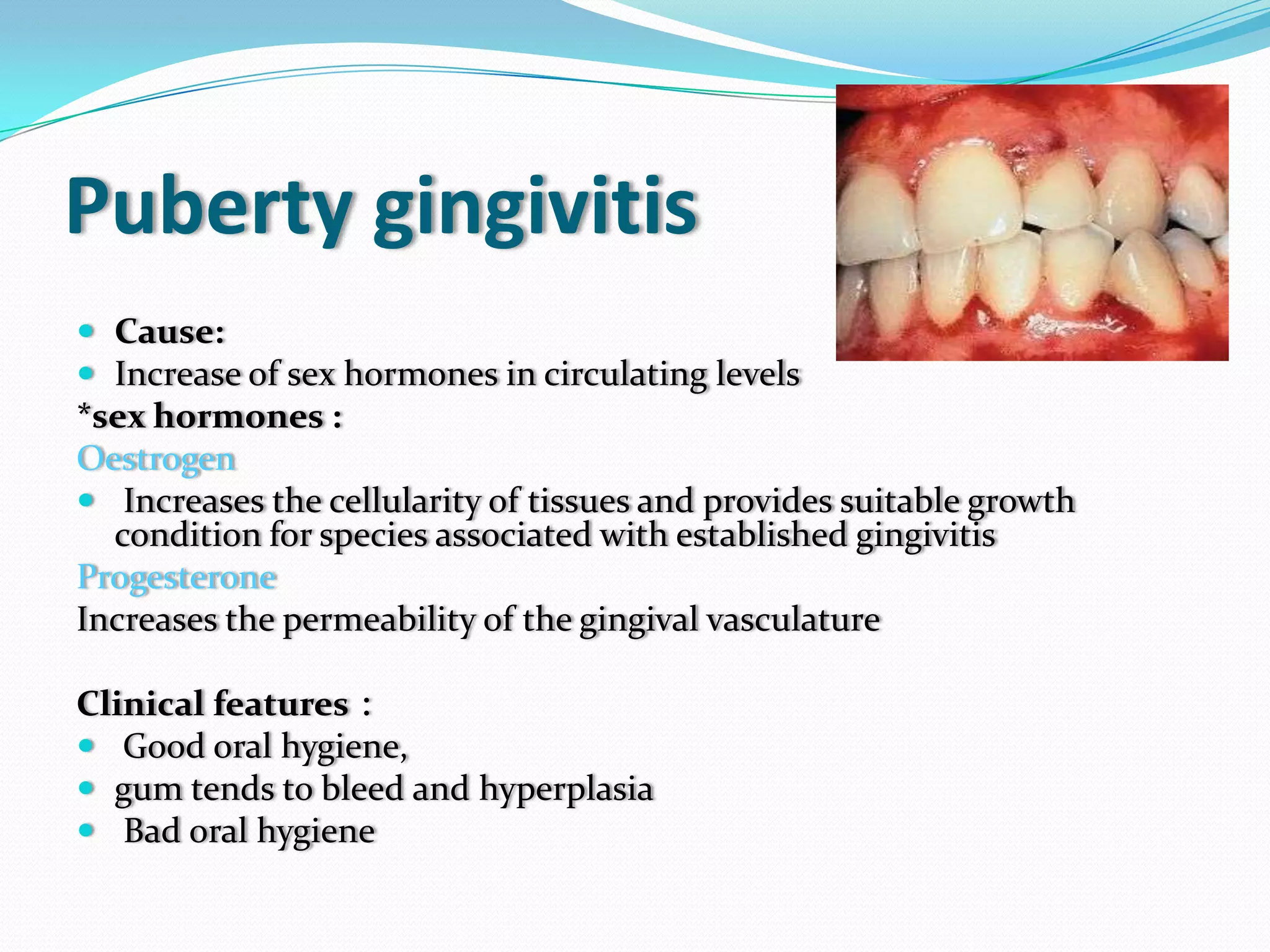 Periodontal diseases in children | PPTX