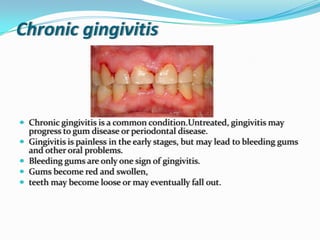 Periodontal diseases in children | PPTX