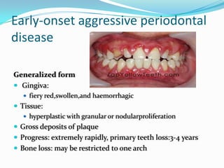 Periodontal diseases in children | PPTX