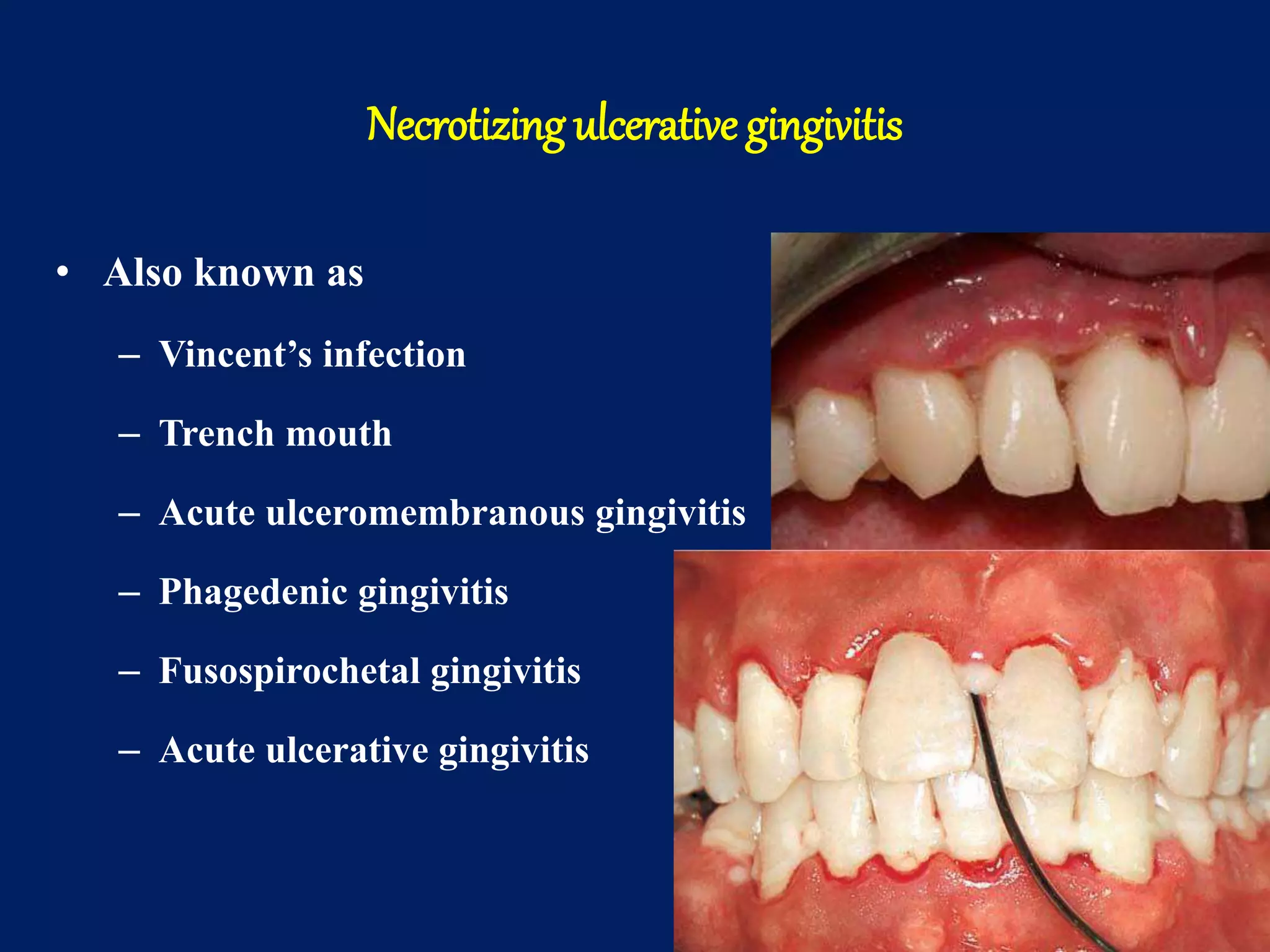 Periodontal diseases ppt | PPTX