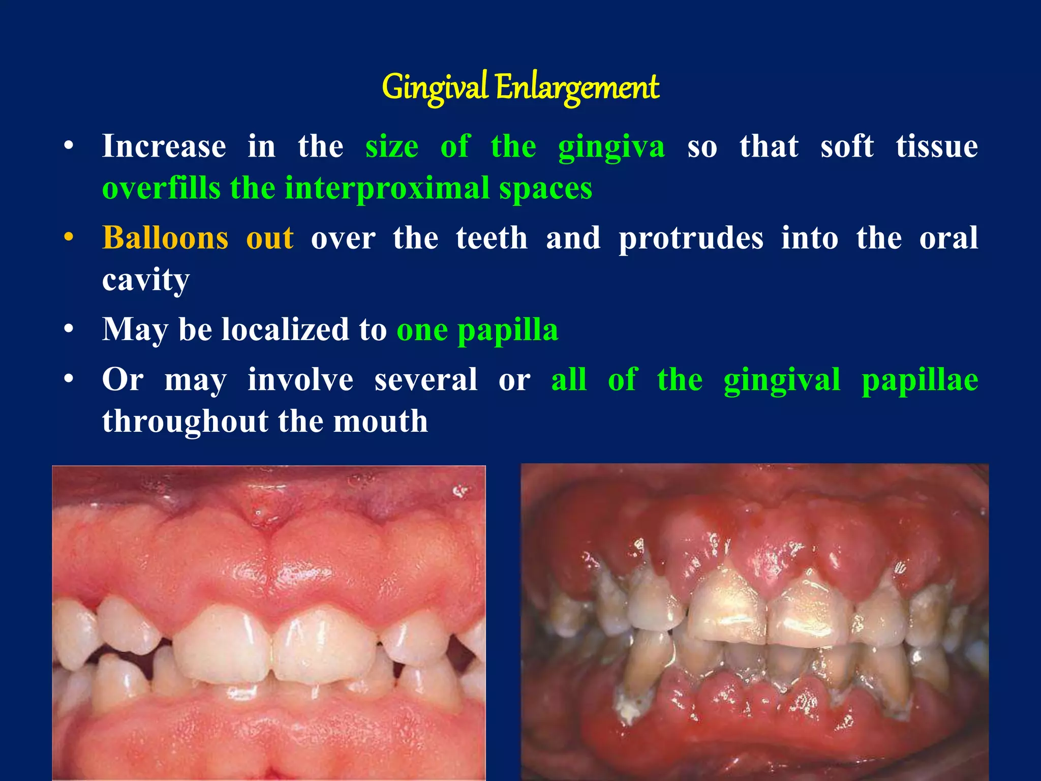 Periodontal diseases ppt | PPTX
