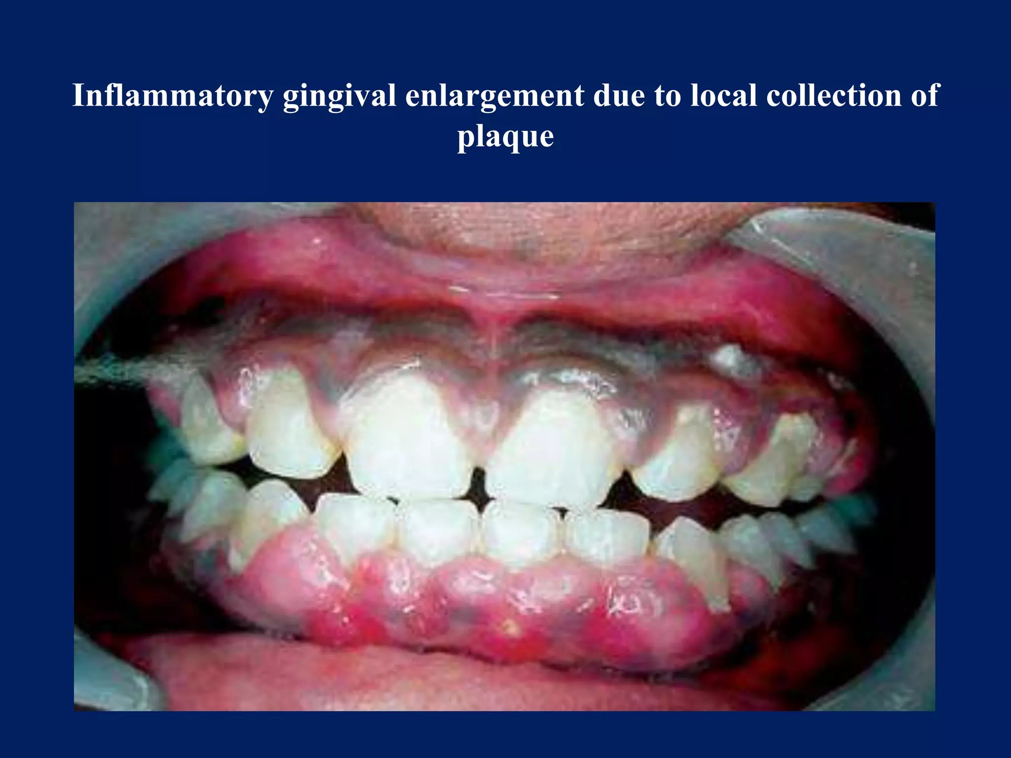 Periodontal diseases ppt | PPTX