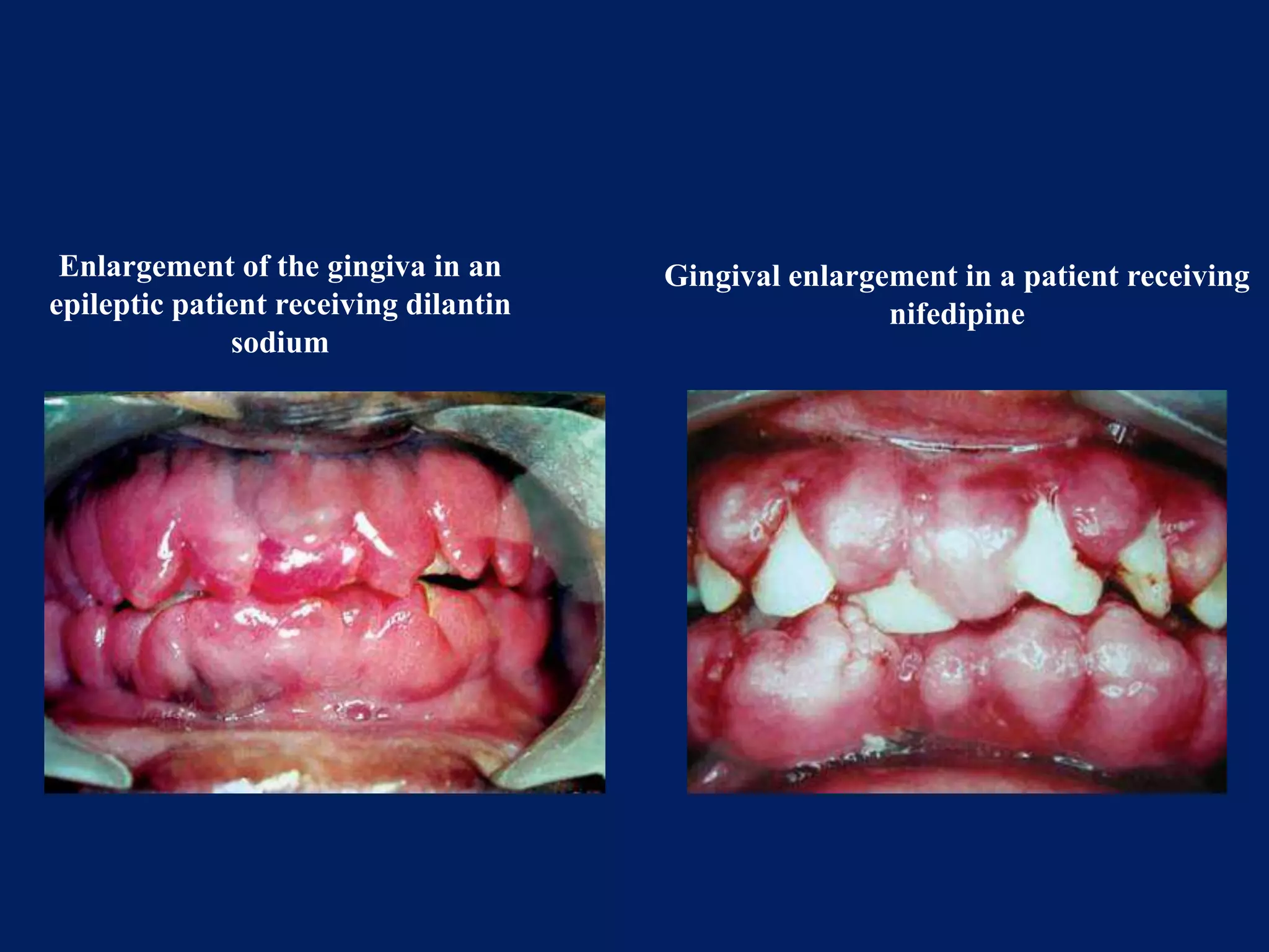 Periodontal diseases ppt | PPTX