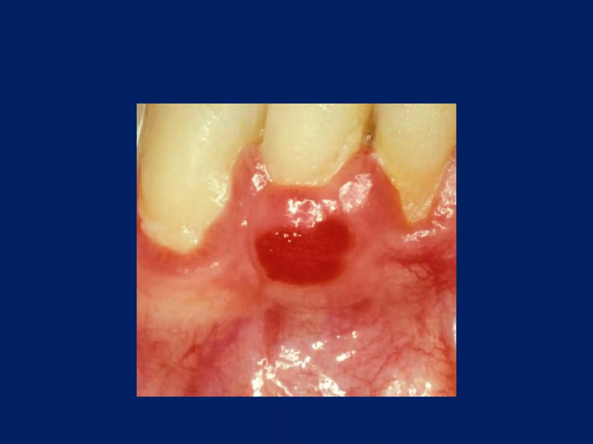 Periodontal diseases ppt | PPTX