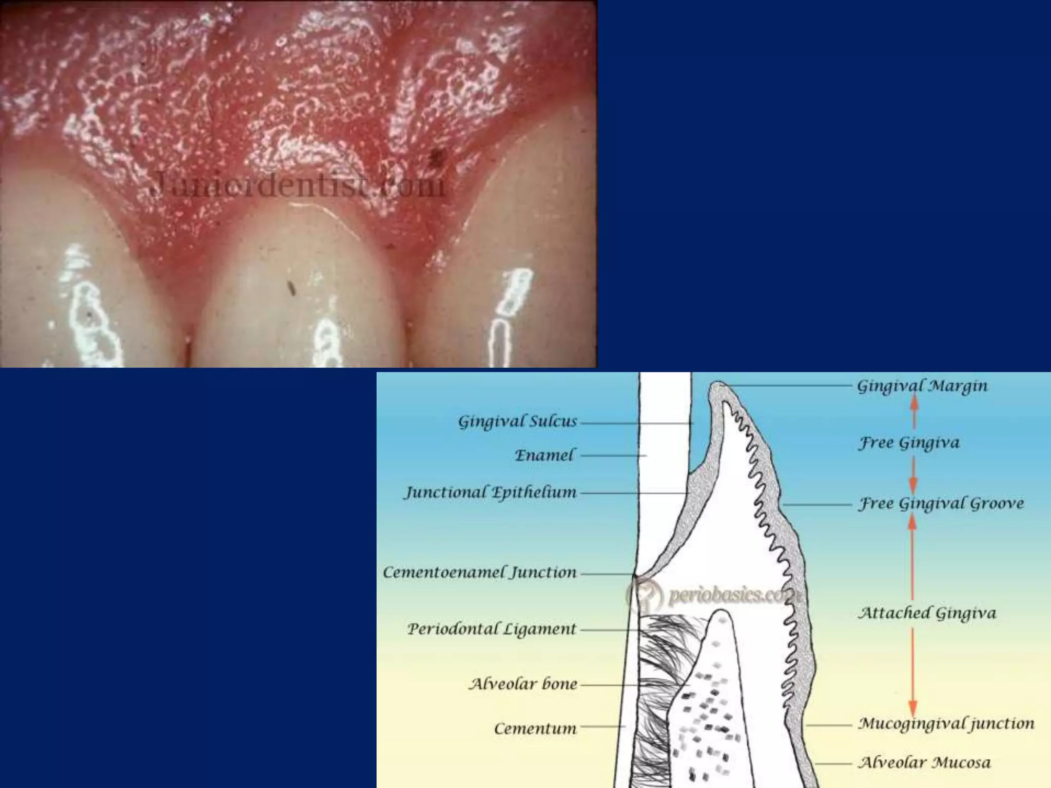 Periodontal diseases ppt | PPTX