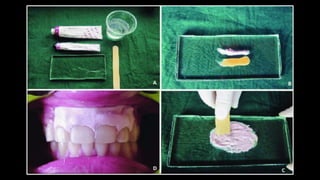 PERIODONTAL DRESSING perio pack - JC.pptx | Oral care | Personal Care