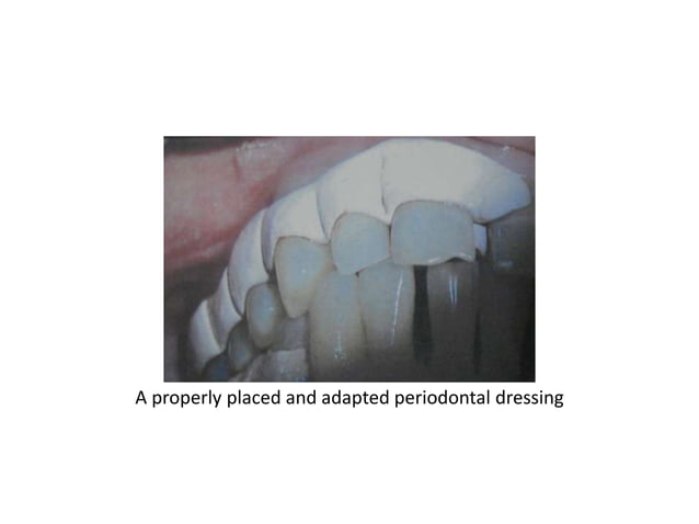 Periodontal dressings | PPTX