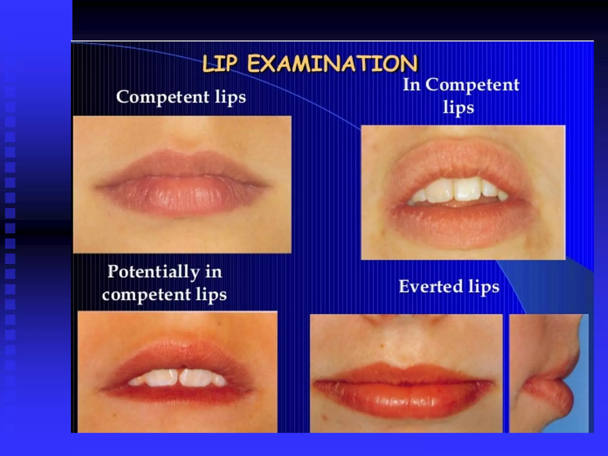 Periodontal examination ,chart. ppt | PDF | Dental Health | Diseases ...
