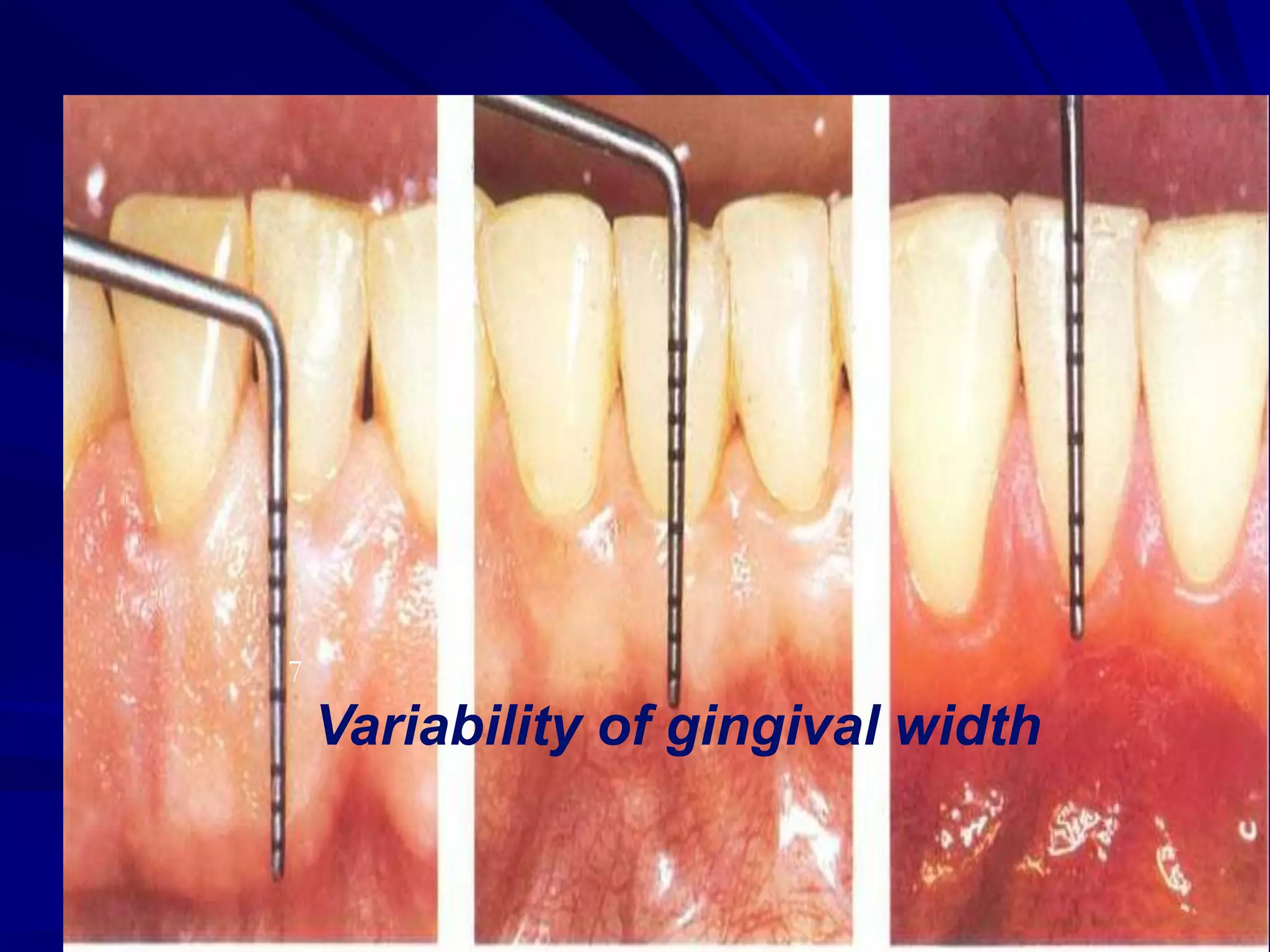 Periodontal examination ,chart. ppt | PDF | Dental Health | Diseases ...