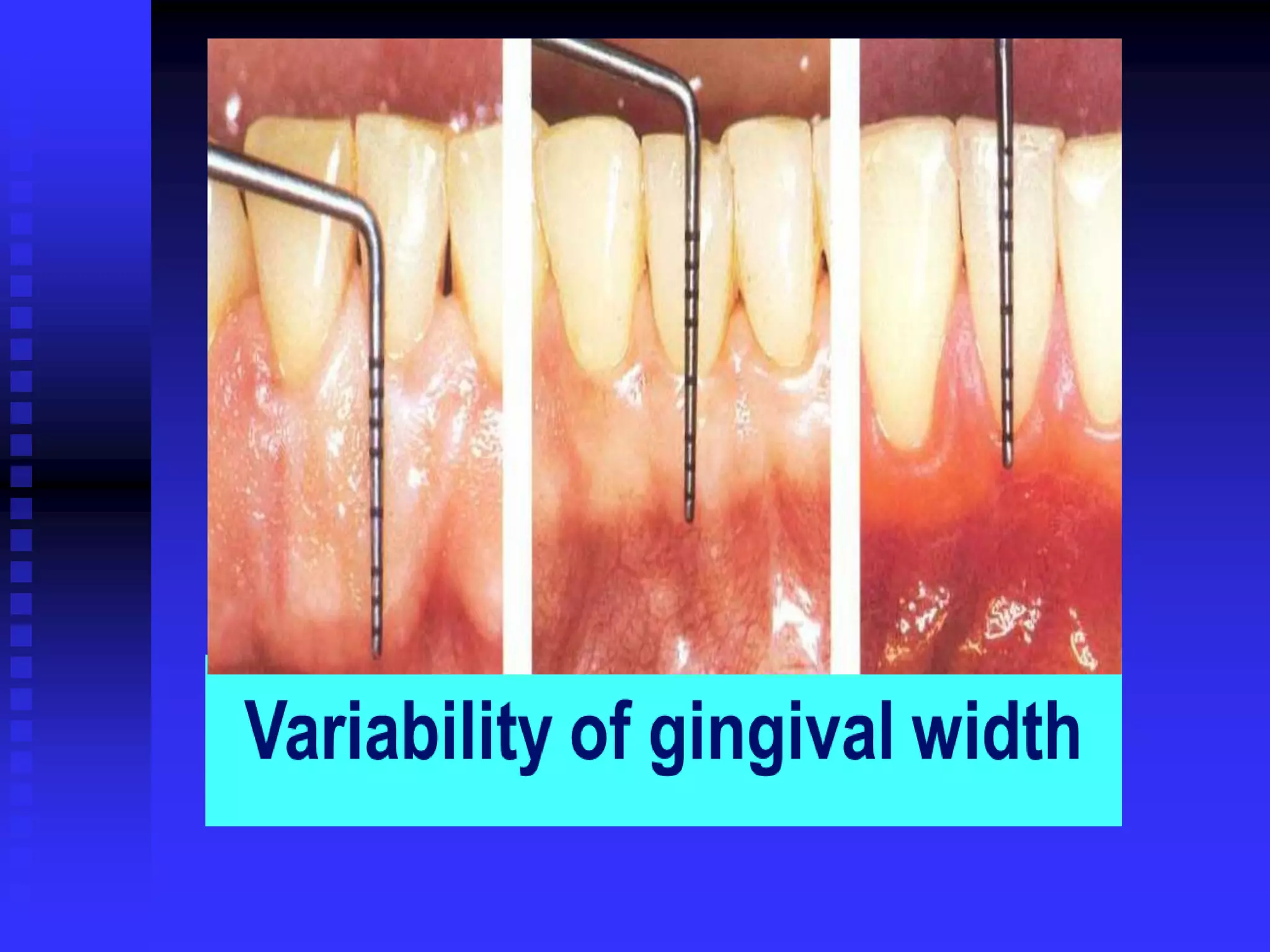 Periodontal examination ,chart. ppt | PDF | Dental Health | Diseases ...