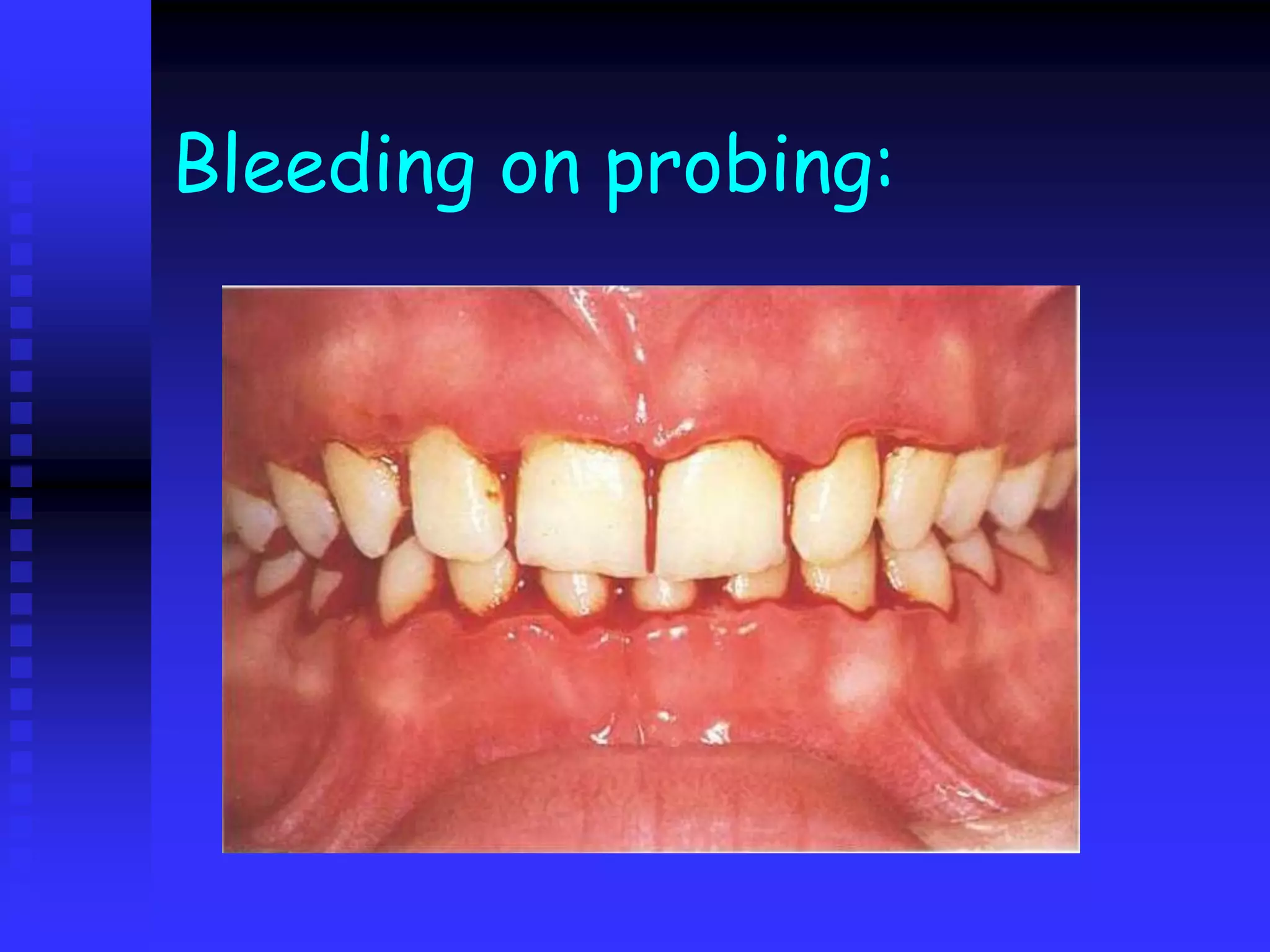 Periodontal examination ,chart. ppt | PDF | Dental Health | Diseases ...