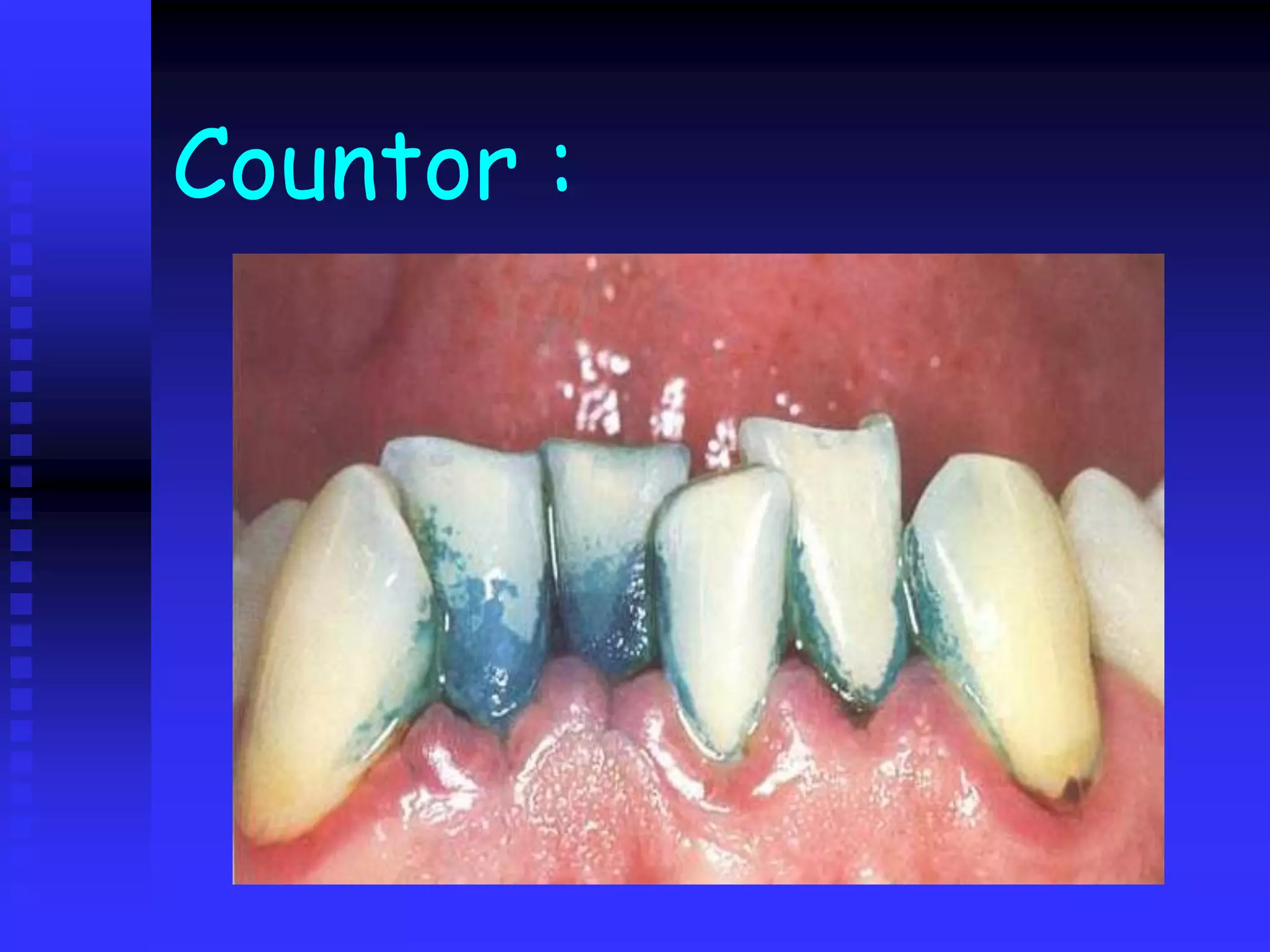 Periodontal examination ,chart. ppt | PDF | Dental Health | Diseases ...