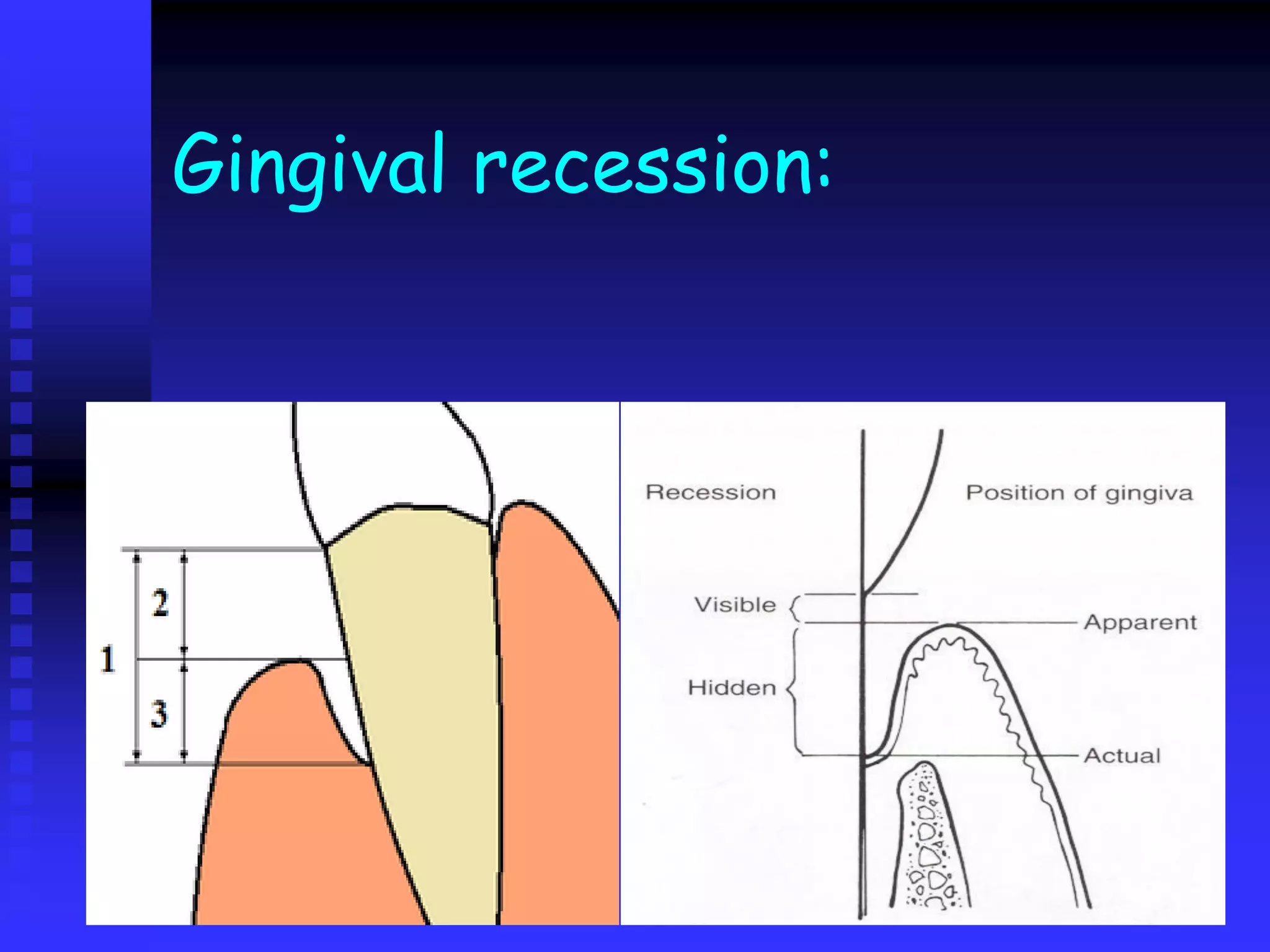 Periodontal examination ,chart. ppt | PDF | Dental Health | Diseases ...