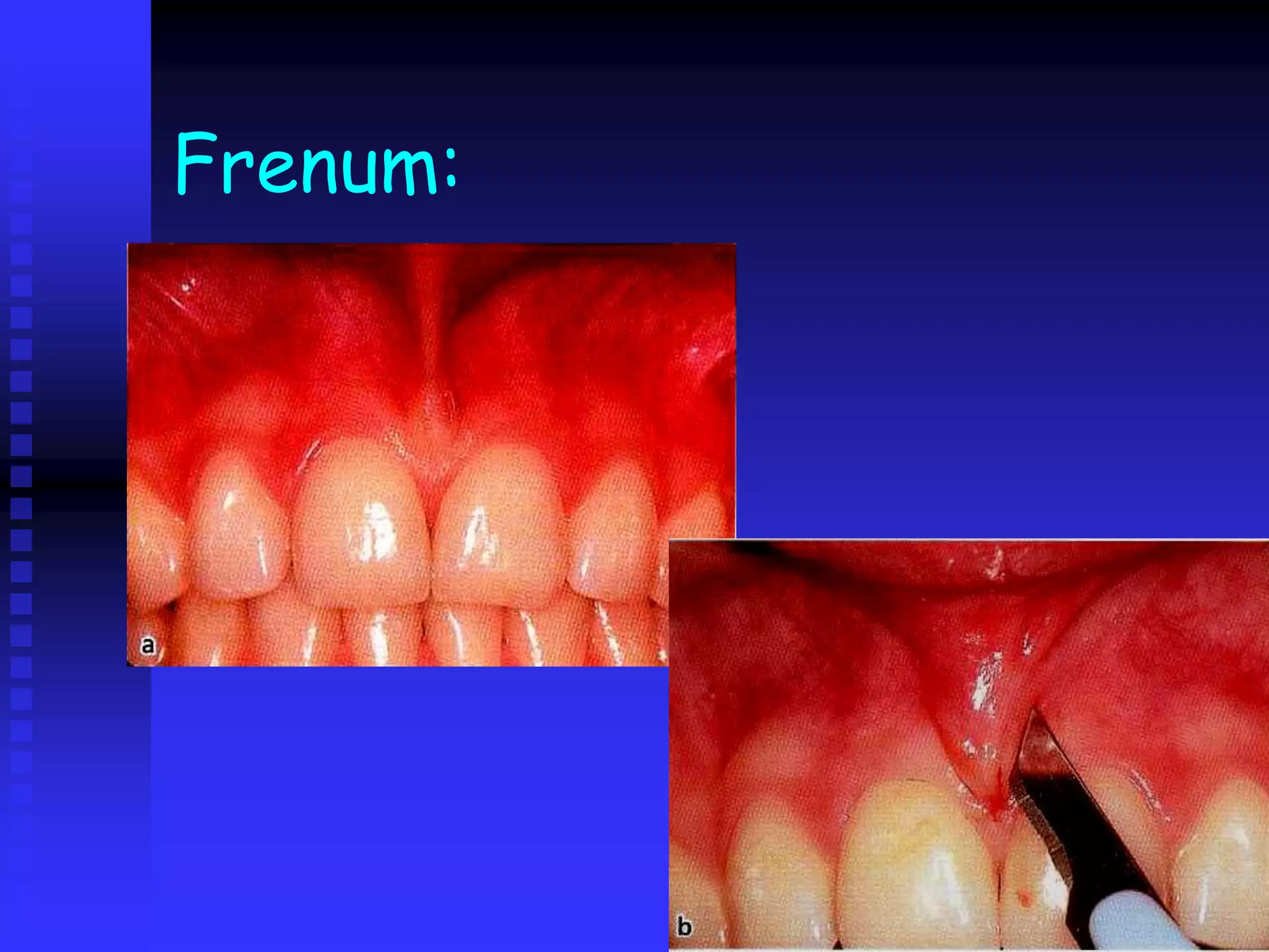Periodontal examination ,chart. ppt | PDF