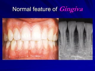Periodontal examination ,chart. ppt | PDF