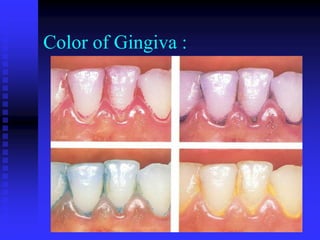 Periodontal examination ,chart. ppt | PDF