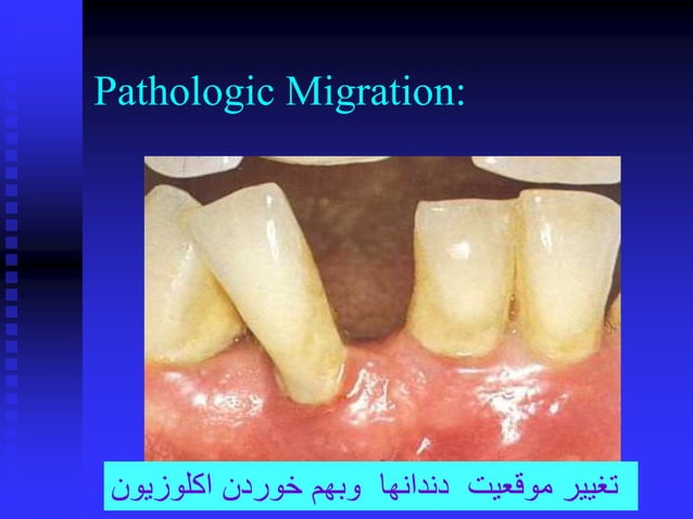 Periodontal examination ,chart. ppt | PDF | Dental Health | Diseases ...