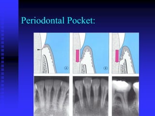 Periodontal examination ,chart. ppt | PDF