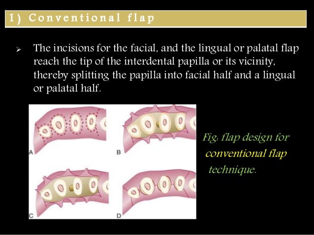 The Periodontal flap