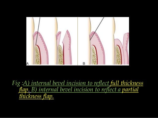 The Periodontal flap